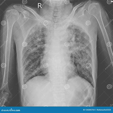 Chest X Ray Showing Interstitial Pulmonary Infiltration With Dry
