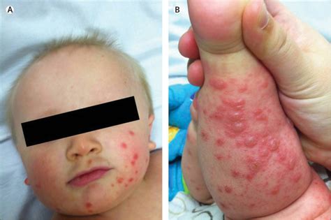 Atypical Hand Foot And Mouth Disease Quotes Sites