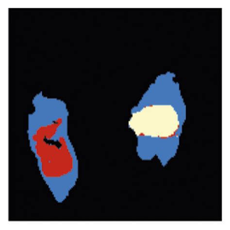 Case 2 Tumor Spread And Metastasis Can Reflect Segmentation Effects On Download Scientific
