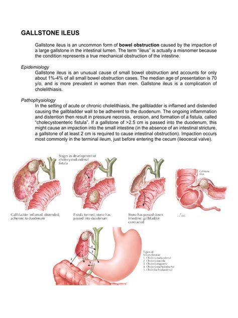 Gallstone Ileus Cc Huevos Haziel M Pdf Clinical Medicine