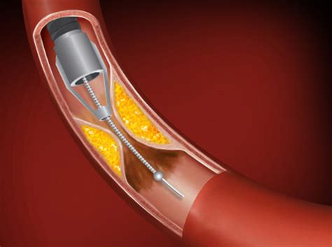 Video Atherectomy Transluminal Healthclips Online