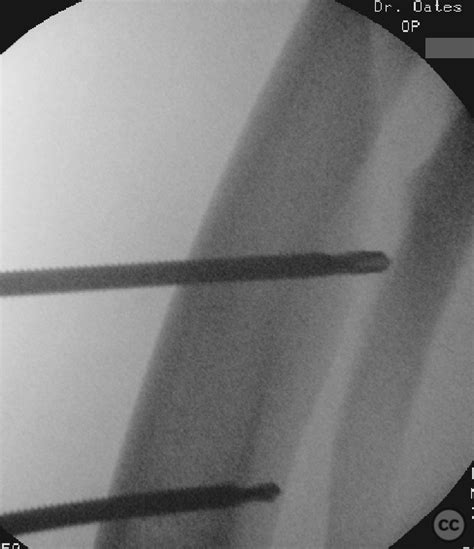 Closed Segmental Comminuted Femoral Fracture