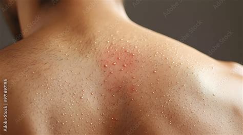 Image Of Back Skin With A Large Red Allergic Rash Showing Visible