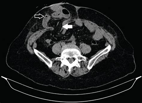 Parastomal Hernia Intechopen