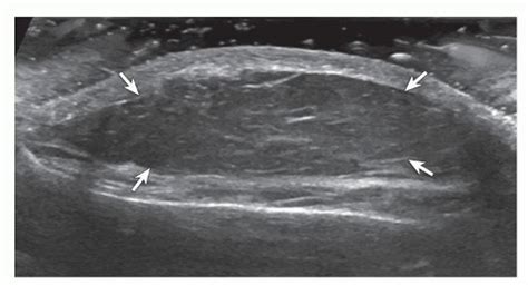 Lipomatous Neoplasm Of Skin Intramuscular Lipoma Symptoms Causes