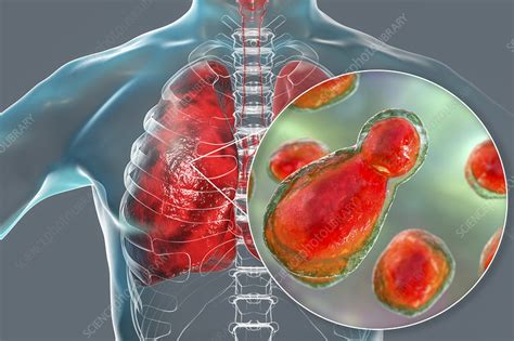 Pulmonary Cryptococcosis Illustration Stock Image F0338018