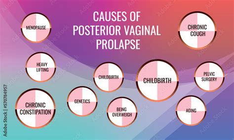 Vetor De Causes Of Posterior Vaginal Prolapse Vector Illustration For