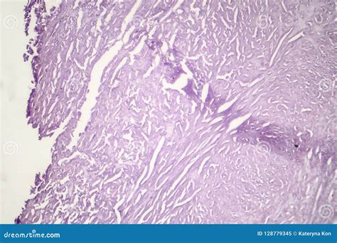 Aortic Atherosclerosis Light Micrograph Stock Image Image Of