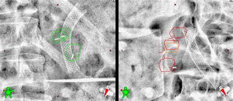 Clinical Real Time Kv Images The Expected Fiducial Marker Locations