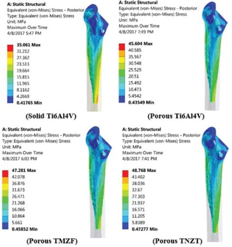 Research Design And Analysis Of A Low Stiffness Porous Hip Stem Biomedical Instrumentation