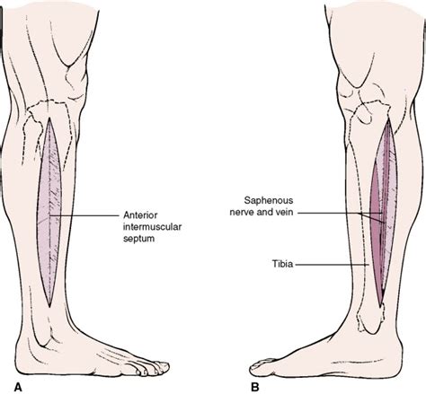 骨科筆記 Fasciotomy