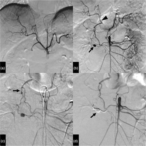 Transcatheter Arterial Embolization In A 53 Year Old Man Presenting