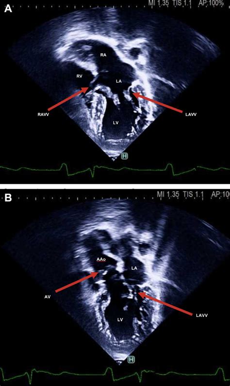 Pre Operative Transthoracic Echocardiogram Download Scientific Diagram