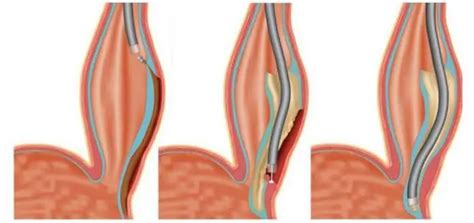 Obstruction Of The Esophagus Causes Symptoms Diagnosis And Treatment