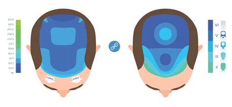 Botox Injections For Hair Growth In Men Hairguard