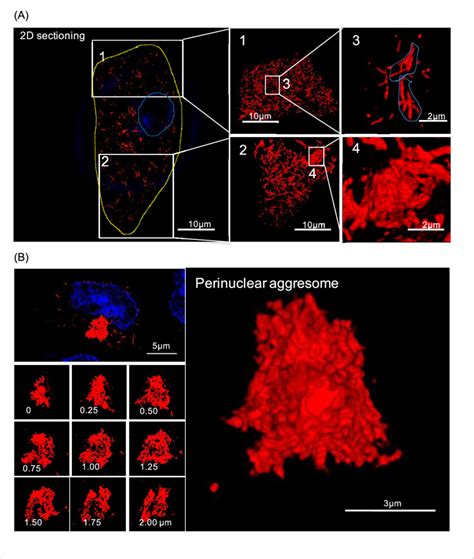 Super Resolved Structures Of Intracellular Arctic Mutant Aggregates