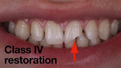 Free Hand Class Iv Restoration Using Simplified Approach And Unica Matrix Youtube