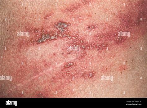 Close Up Of Lesions From A Shingles Rash On The Back In A 73 Year Old