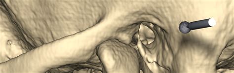 voxel man my cases surgical training cases from ct and cbct