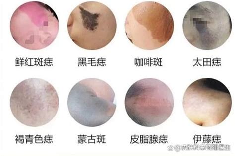 胎记会遗传吗？