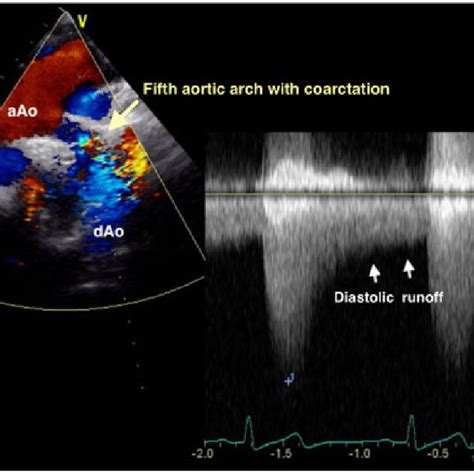 Suprasternal View In Transthoracic Echocardiography Showing Flow