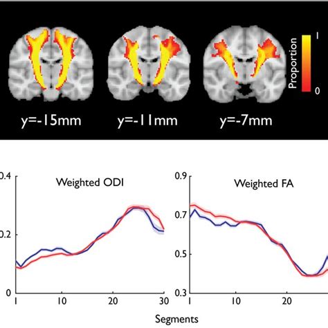 A Group Based Image Of The Corticospinal Tract Cst The Voxel