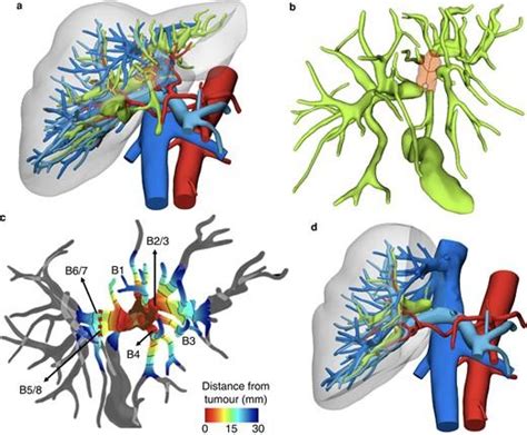 Medics On Linkedin Perihilar Cholangiocarcinoma Three Dimensional