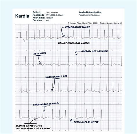 Charts Ai Diagnoses Atrial Fibrillation In Normal Sinus 46 Off