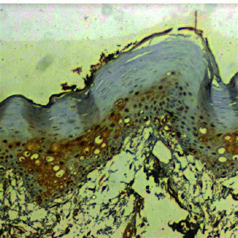 Ihc For Egfr In Dysplasia Under 20× Magnification Download
