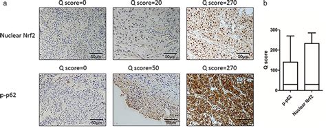 Representative Ihc Staining Of P‐p62 And Nuclear Nrf2 A