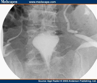 Pelvic Lipomatosis