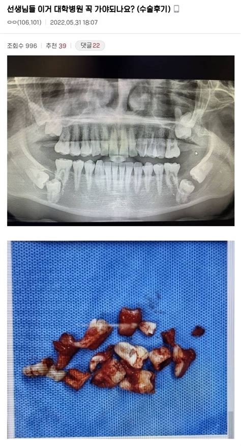 사랑니 갤러리 레전드… ㅎㅇㅈㅇ 인스티즈 Instiz 인티포털 카테고리