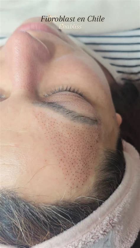 Cosmetologa Con Isp Especialista En Fibroblast Con Plasmed
