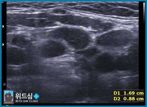갑상선병원 목 임파선염 증상 관찰 경부초음파검사 사례 네이버 블로그