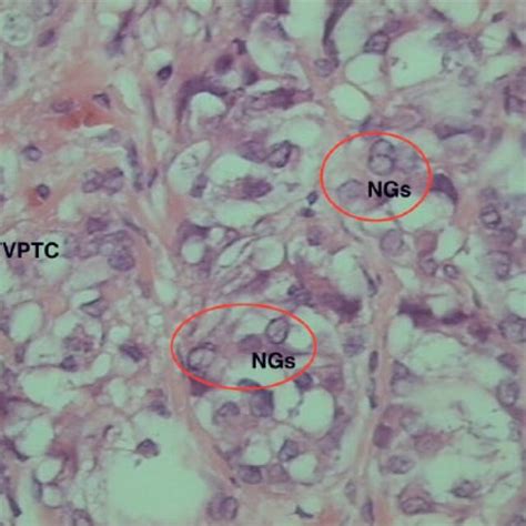 High Power Magnification Of Follicular Variant Papillary Thyroid