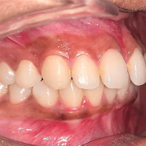 Pretreatment Right Lateral View Showing Angles Class I Molar And