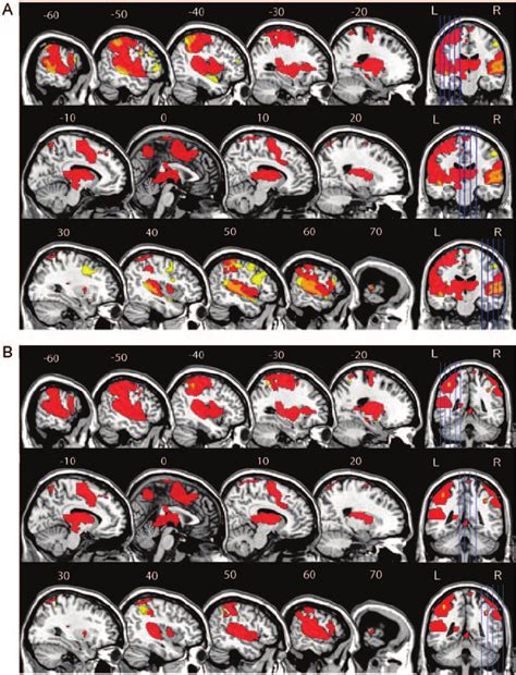A The Regions That Were Activated In Both The Auditory Spatial Download Scientific Diagram