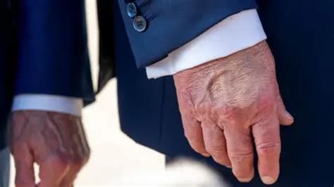 What Is Trumps Vein Condition And How Serious Is It