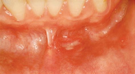 Oral Manifestations Of Systemic Disease Aafp