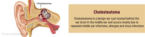Symptoms And Signs Of Cholesteatoma