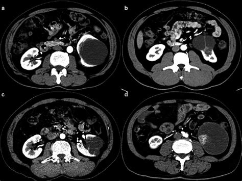 Deep Learning And Radiomic Feature Based Blending Ensemble Classifier