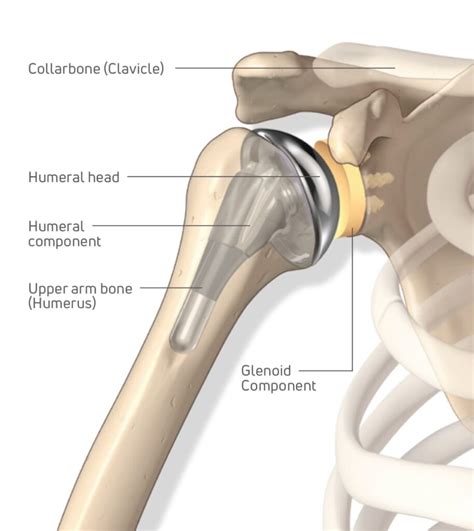Shoulder Replacement Midwest Center For Joint Replacement