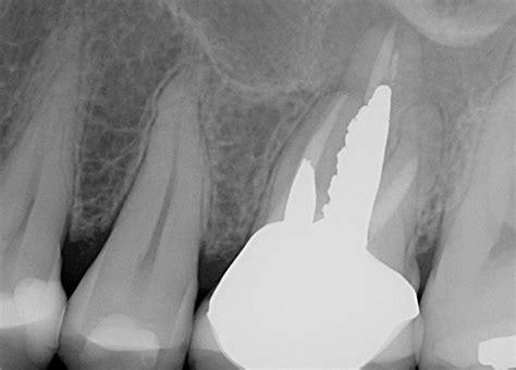 Socket Preservation Dr Jill Levine Toronto Periodontist