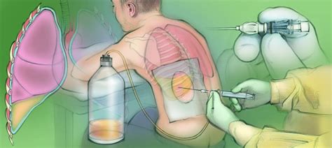 Thoracentesis — The Interventional Initiative