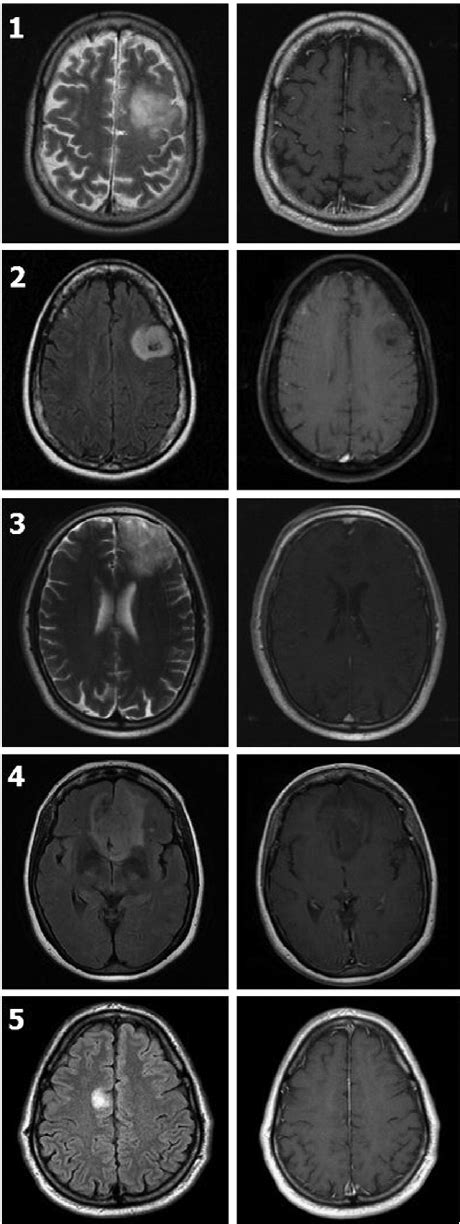 Radiologic Characteristics Of Tumors Of The Favorable Prognosis Group