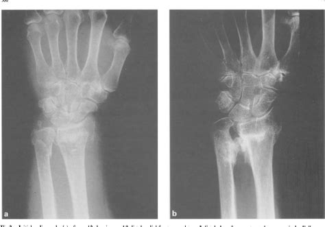 Ulna Fractures Semantic Scholar