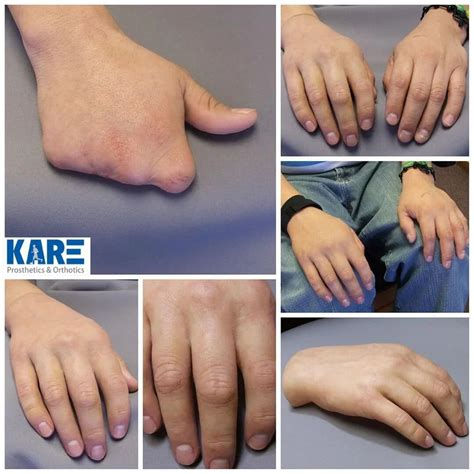 Cosmetic Silicone Partial Finger Prosthesis At ₹ 15000piece In
