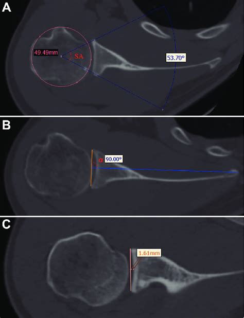 Measurements On An Axial Computed Tomography Plane Of A Right Shoulder