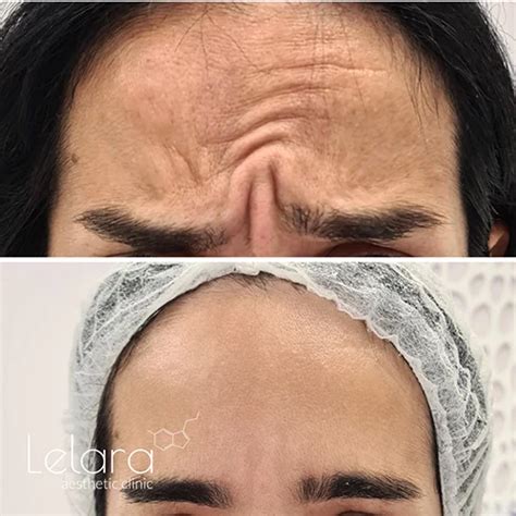 Botox Treatment In Dubai Smooth Wrinkles And Enhance Your Look Lelara