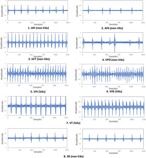 Figure 1 From Tinyml Design Contest For Life Threatening Ventricular Arrhythmia Detection